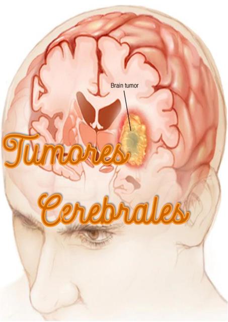 Tumores Cerebrales | Med.Resumenes | uDocz
