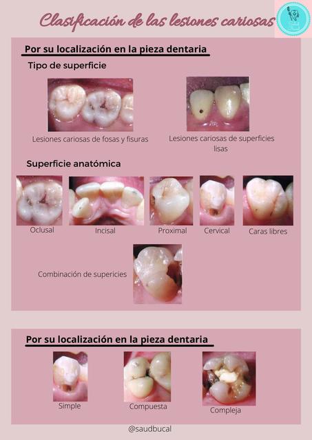 Clasificación de las lesiones cariosas | Salud bucal | uDocz