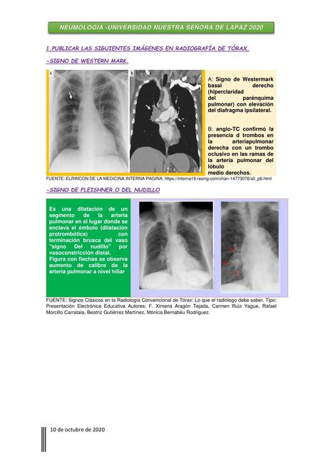 Embolismo pulmonar | KRUZKAYA MACHICADO M. | uDocz