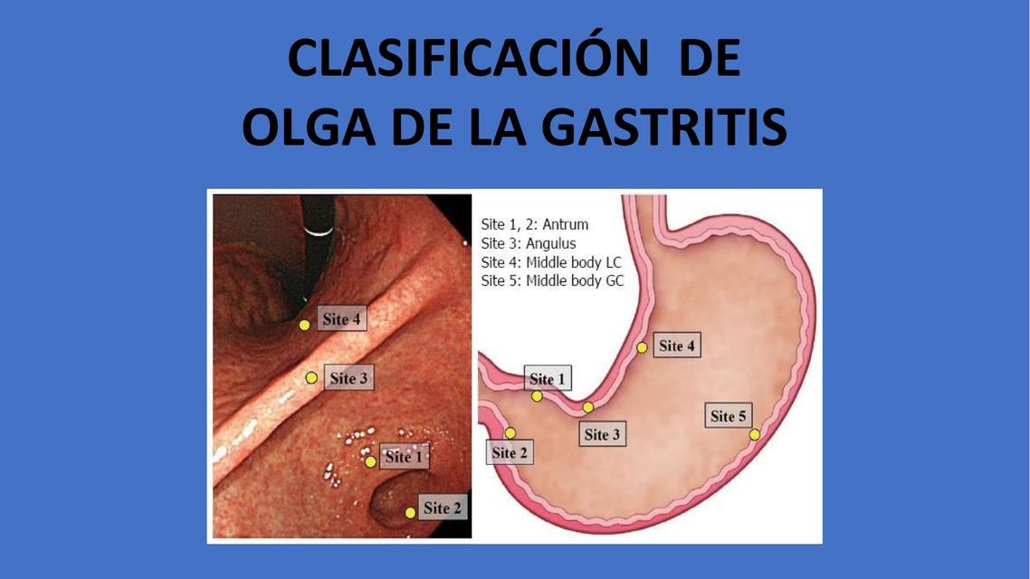 Clasificación de la gastritis | CUESTIONARIOS MEDICINA 👨‍⚕️📚 | uDocz
