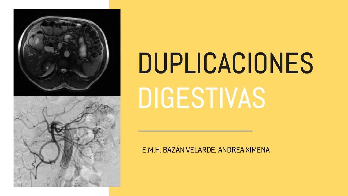 Duplicaciones Digestivas | BAZAN VELARDE ANDREA XIMENA | uDocz