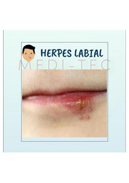 Herpes Labial | MediTec-BG | uDocz