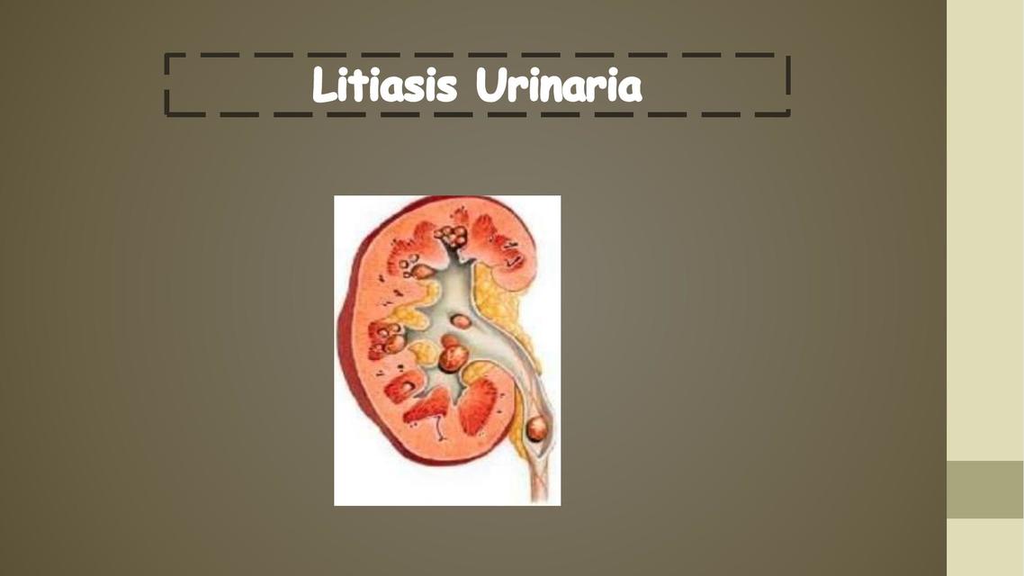 Resúmenes de Litiasis urinaria | Descarga apuntes de Litiasis urinaria