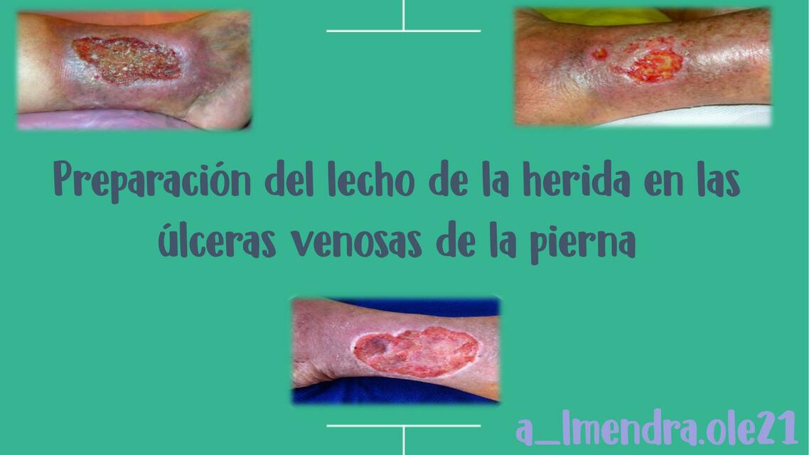 Úlceras Venosas de la Pierna | Almendra LS | uDocz
