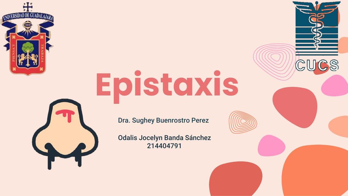 Resúmenes de Epistaxis | Descarga apuntes de Epistaxis