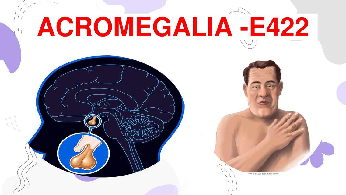 Acromegalia