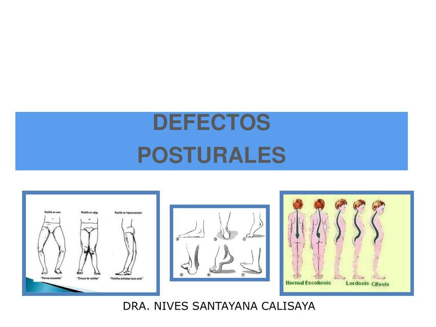 Flashcards de Defectos Posturales | Por Kor PerSa | uDocz