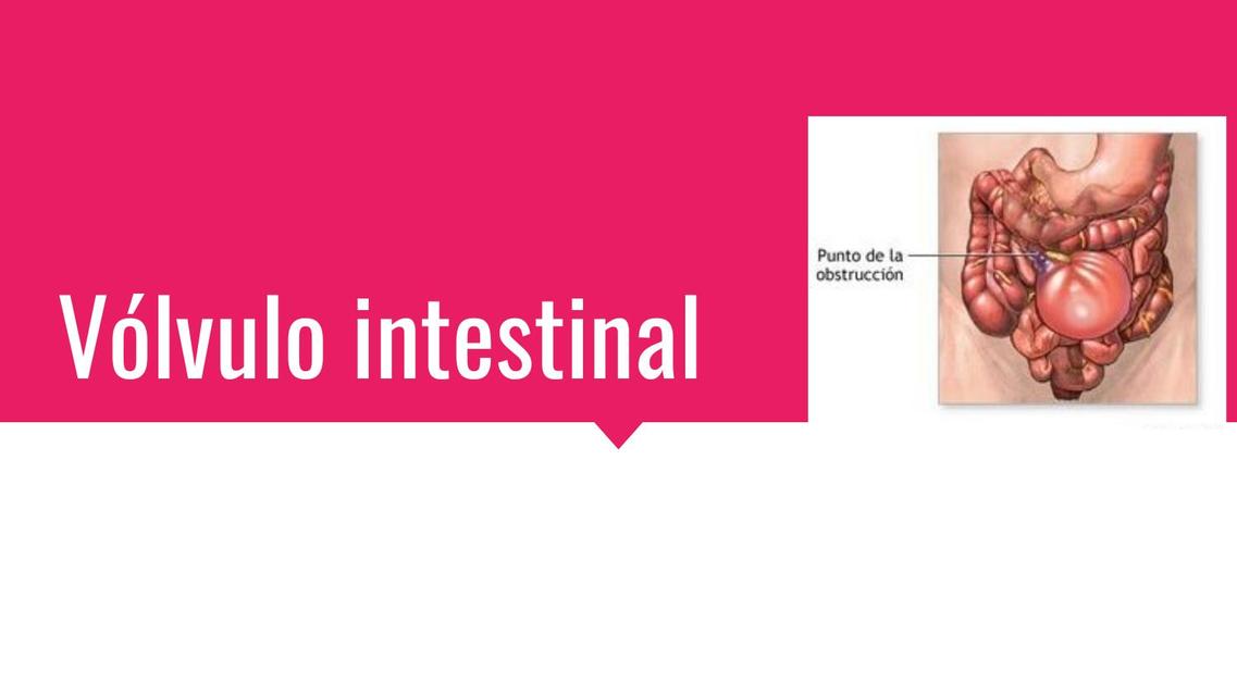 Vólvulo intestinal | Dra. Tramadol | uDocz
