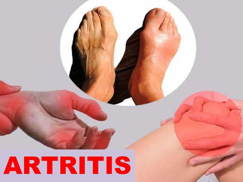 Artritis | Marianela Pinto | uDocz