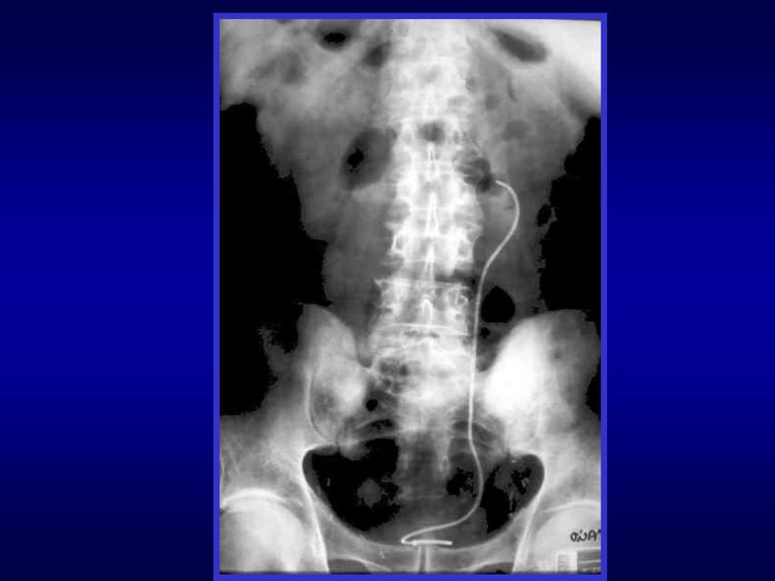 Urolitiasis | Ahmed Casana | uDocz