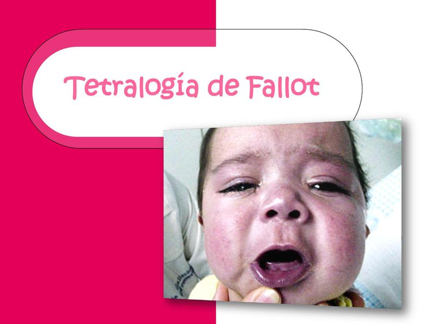 Resúmenes de Tetralogía de Fallot | Descarga apuntes de Tetralogía de ...