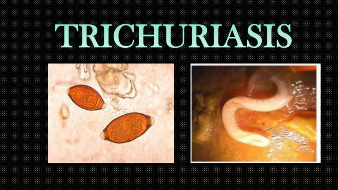 Trichuriasis