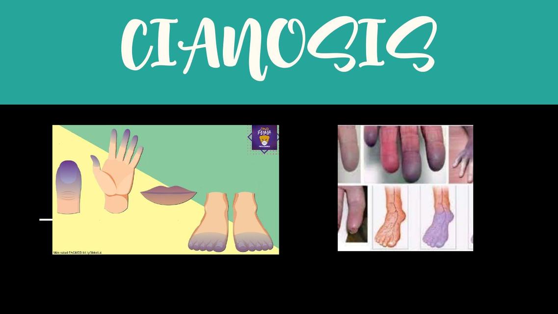 Cianosis | @melanyccama | uDocz