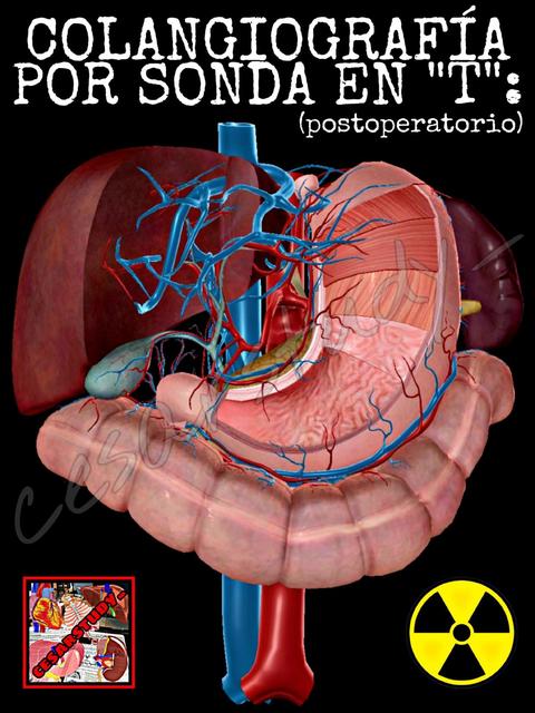 Colangiografía por sonda en T | Cesarstudy_ | uDocz