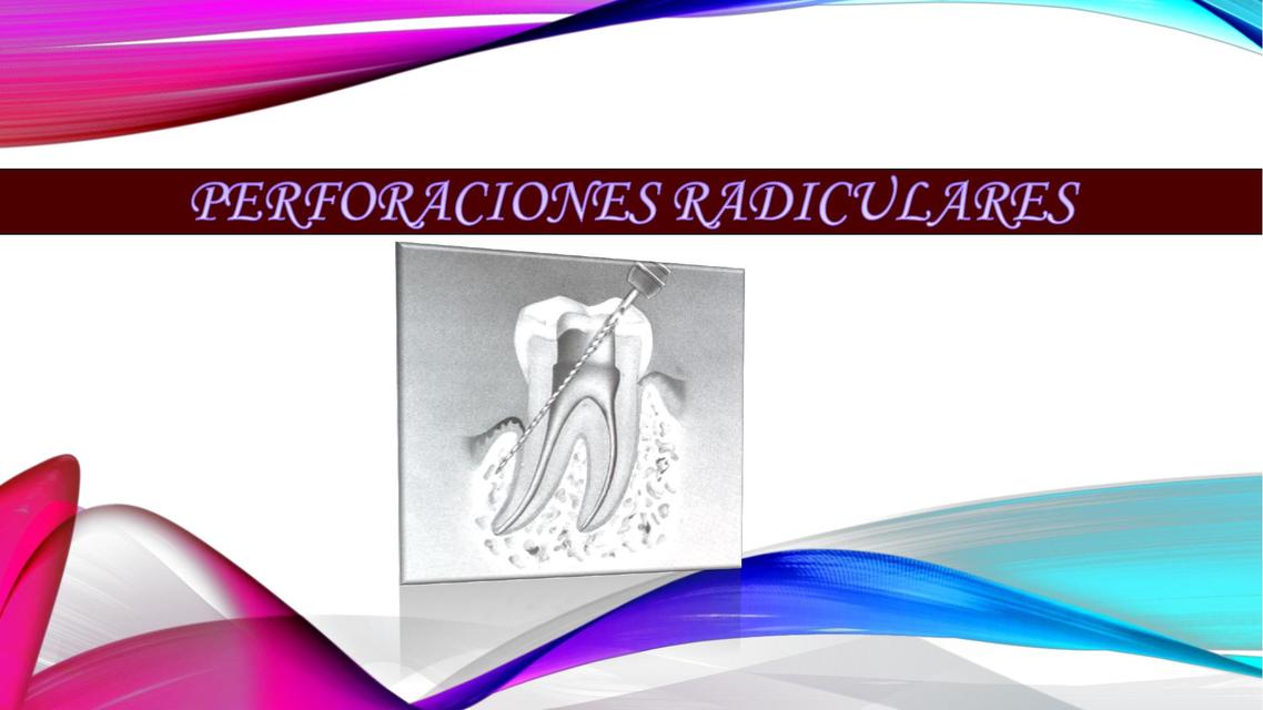 Perforaciones Radiculares | Olga Vasquez | uDocz