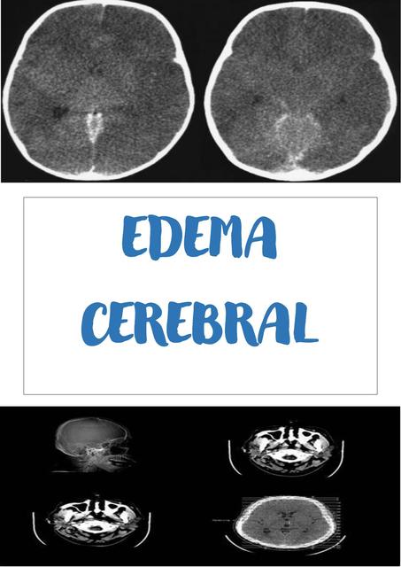 Edema Cerebral Ariella Ferreiras Udocz
