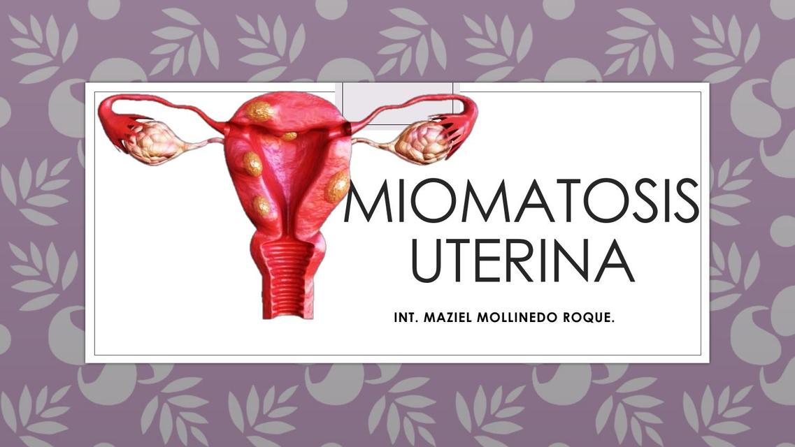 Resúmenes de Miomatosis uterina | Descarga apuntes de Miomatosis uterina
