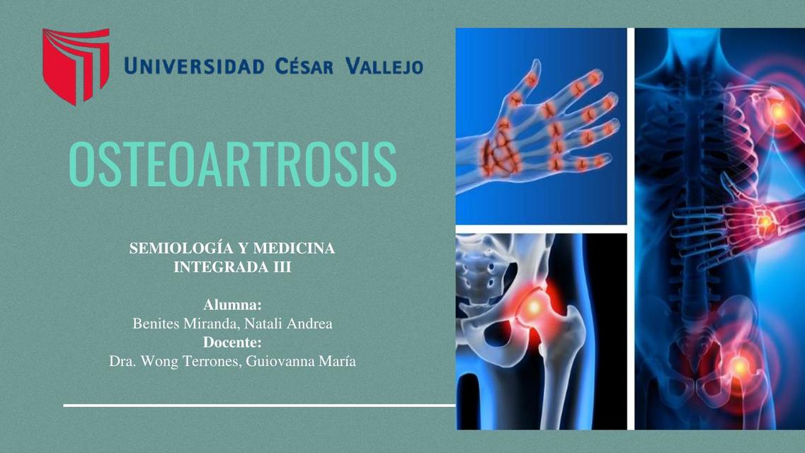Osteoartrosis | uDocz creators | uDocz