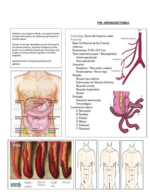 PAE Apendicectomía | Tiare Saavedra | uDocz