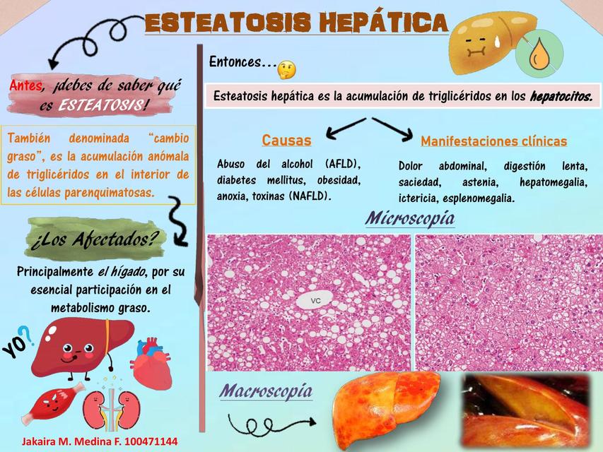 Esteatosis Hepática | Jakaira Medina | uDocz
