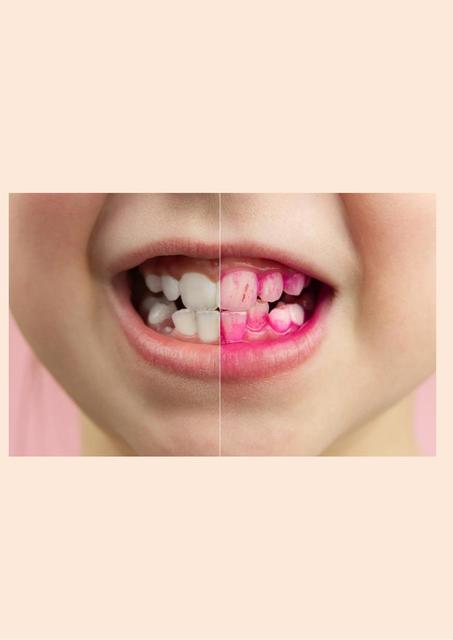 Placa Bacteriana | Nicol Jhoselin Arancibia | uDocz