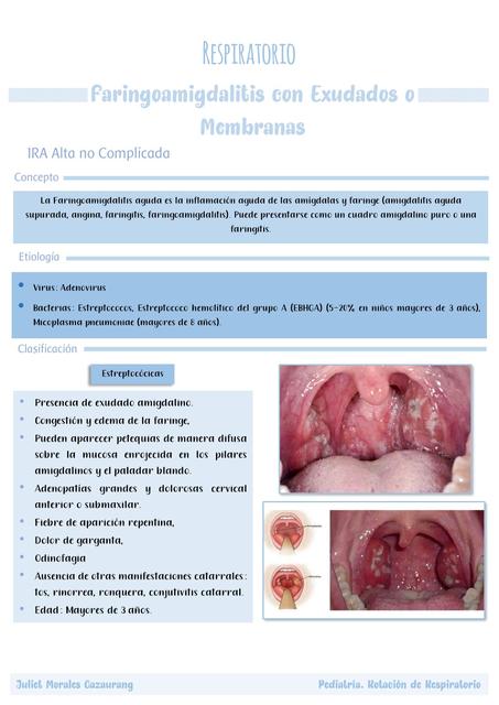 Faringoamigdalitis con Exudados o Membranas | Juliet Morales Cazaurang ...