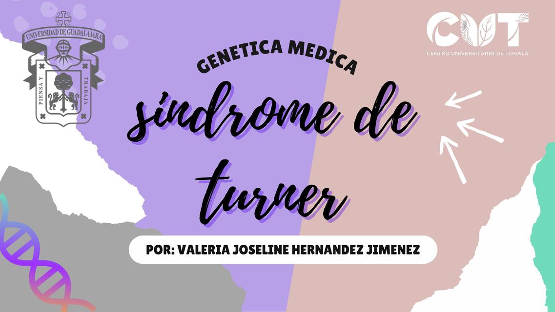 Sindrome De Turner