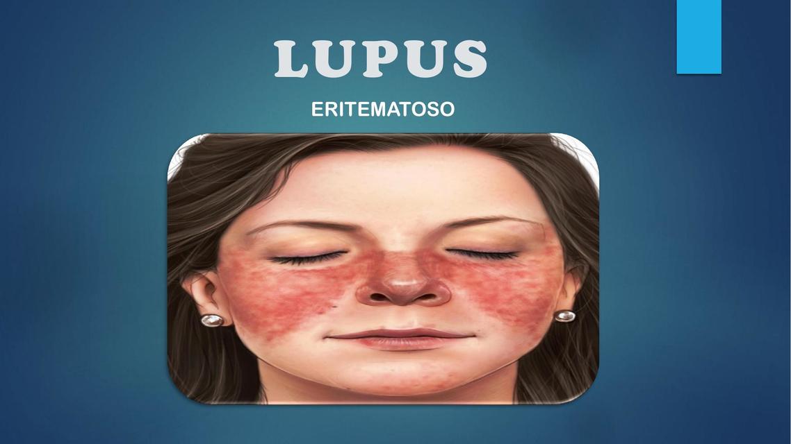 Lupus | nursing apuntes | uDocz