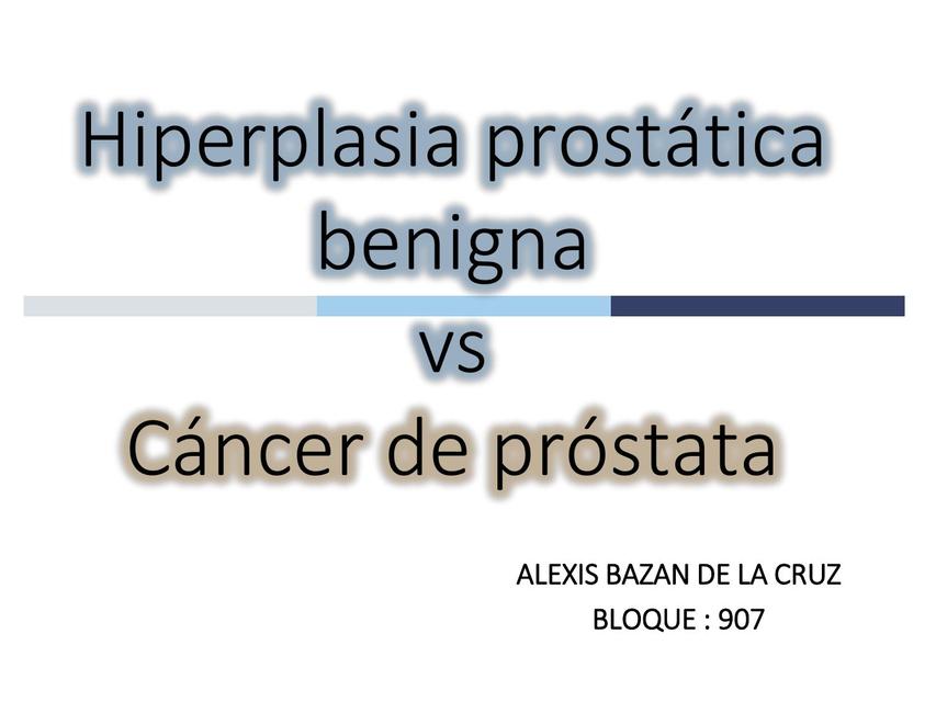 Hiperplasia Prostática Benigna vs Cáncer de Próstata | Alexis Bazan | uDocz