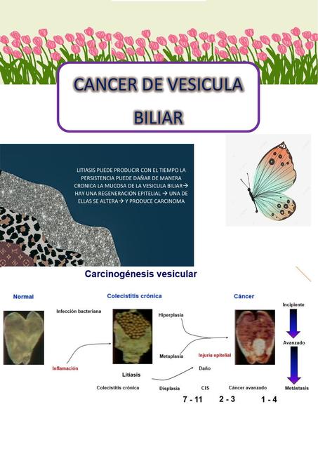 Cáncer de Vesícula Biliar | LIZ SAGASTEGUI | uDocz