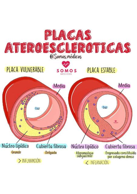 Placas Ateroescleróticas | Fanpage Somos Médicos | uDocz