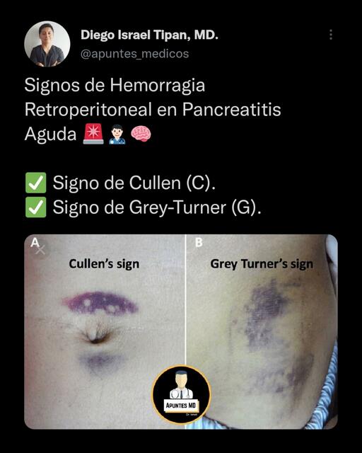 Signos de hemorragia retroperitoneal | Apuntes Médicos - Dr. Israel ...