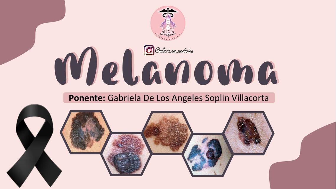 Melanoma | Alicia en Medicina by Gabriela Soplin Villacorta | uDocz