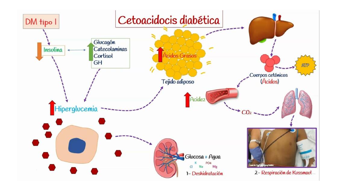 Cetoacidosis Diabética Jhulinio Choque Escarcena Udocz
