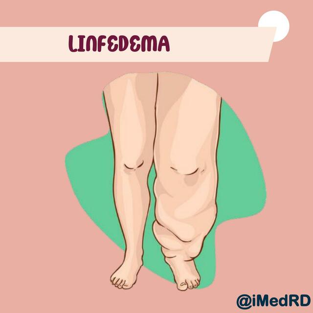 Linfedema | iMedRD | uDocz