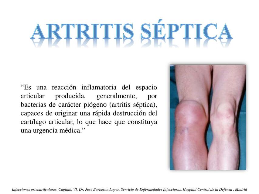 Artritis Septica | José Luis Pérez Camacho | uDocz