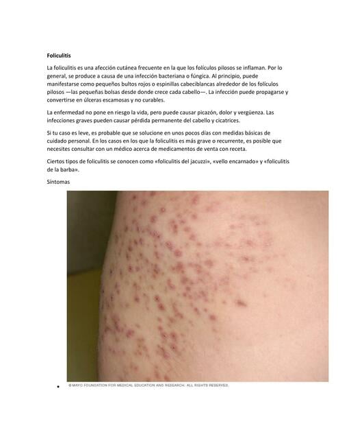Resúmenes de Foliculitis | Descarga apuntes de Foliculitis