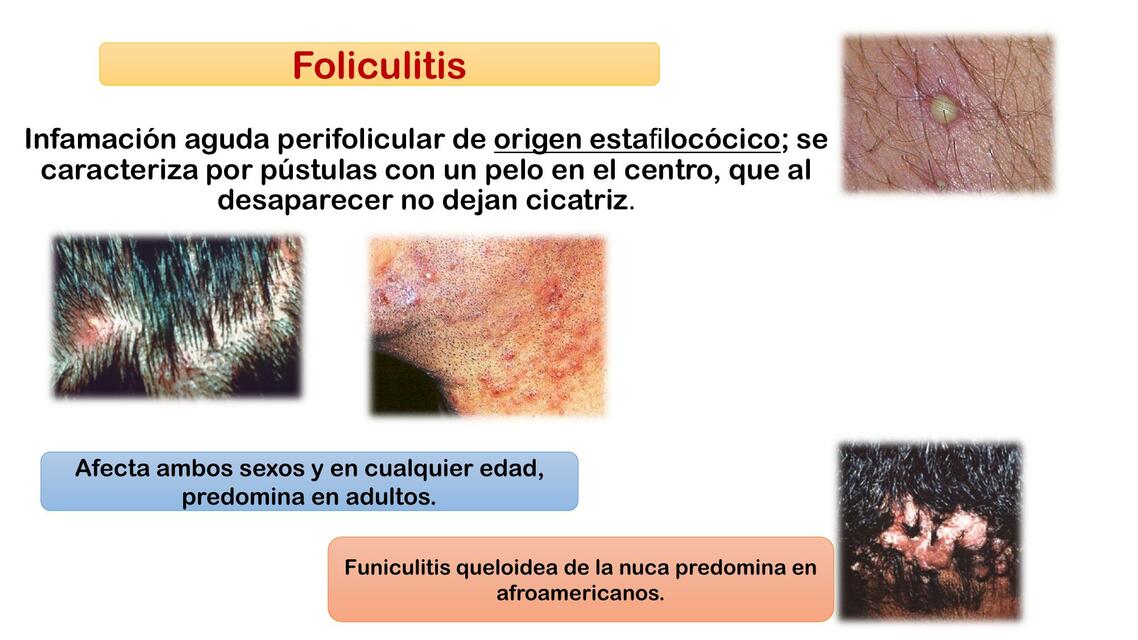 Resúmenes de Foliculitis queloidea | Descarga apuntes de Foliculitis ...