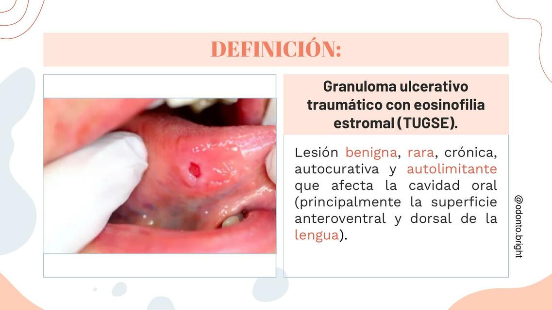 Granuloma Ulcerativo Traumático con Eosinofilia Estromal (TUGSE ...