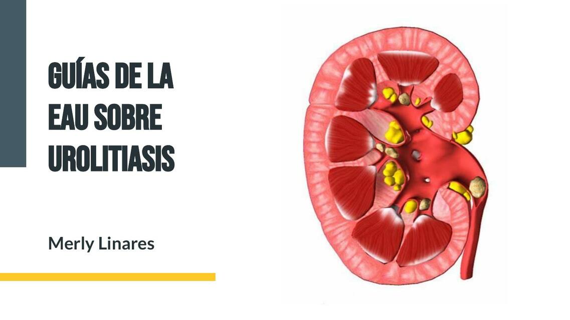 Manejo de la urolitiasis | Sabiduría Médica | uDocz