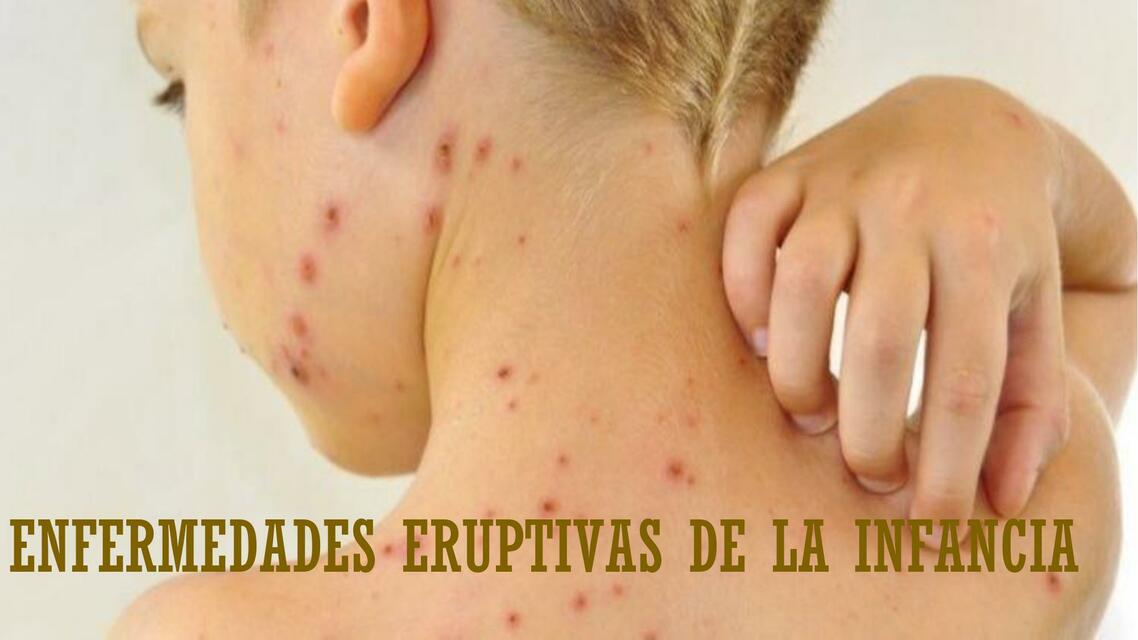 Enfermedades Eruptivas de la Infancia | Wis Dura | uDocz