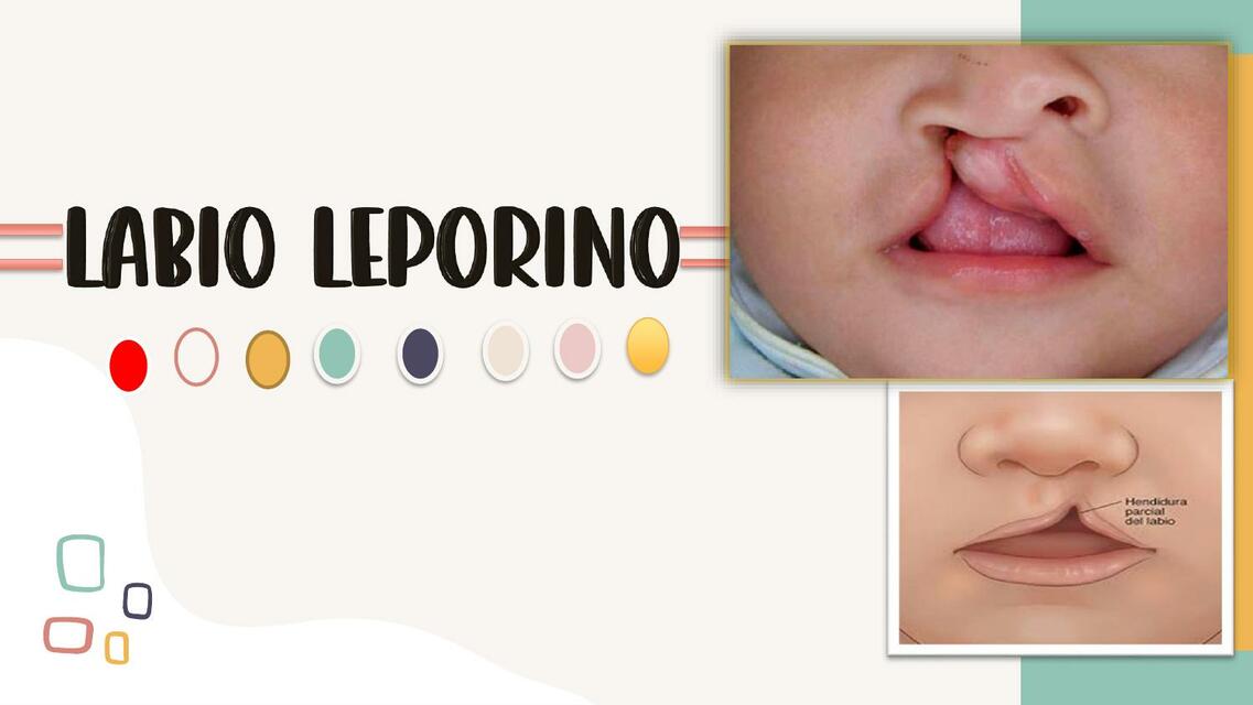 Labio Leporino | ange230 | uDocz