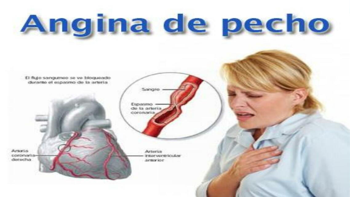 Angina de Pecho | Mario Doctor | uDocz