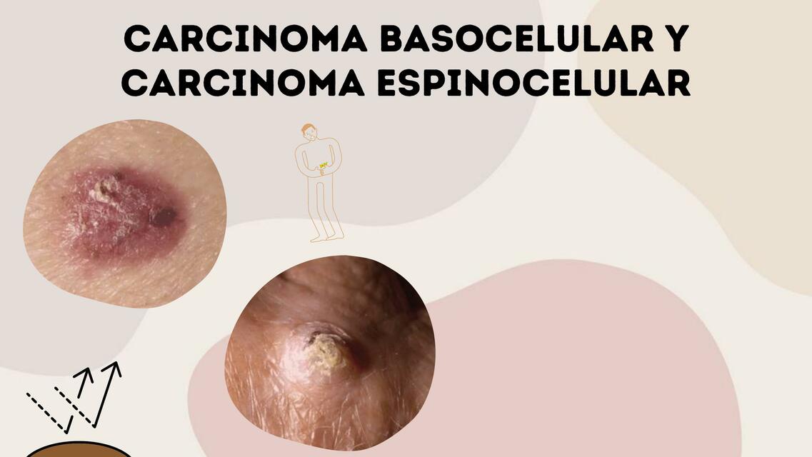 Carcinoma Basocelular y Carcinoma Espinocelular | Brissa Moreno | uDocz