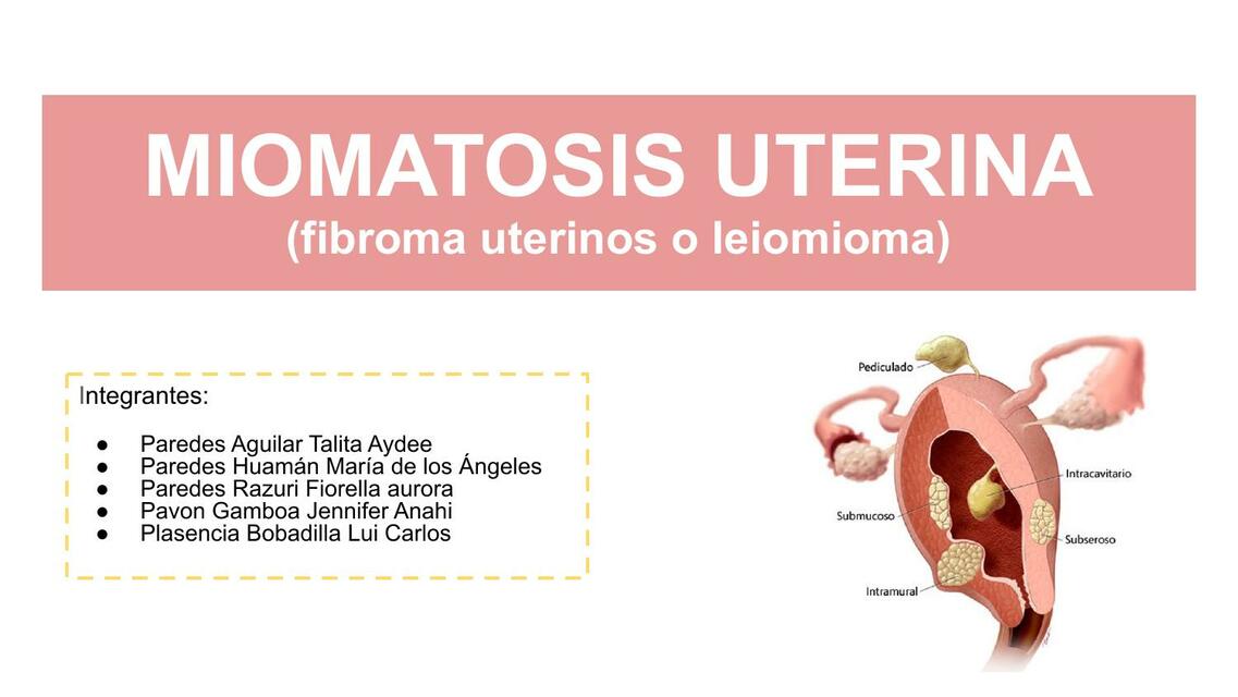 Miomatosis y Pólipos | Fiorella | uDocz