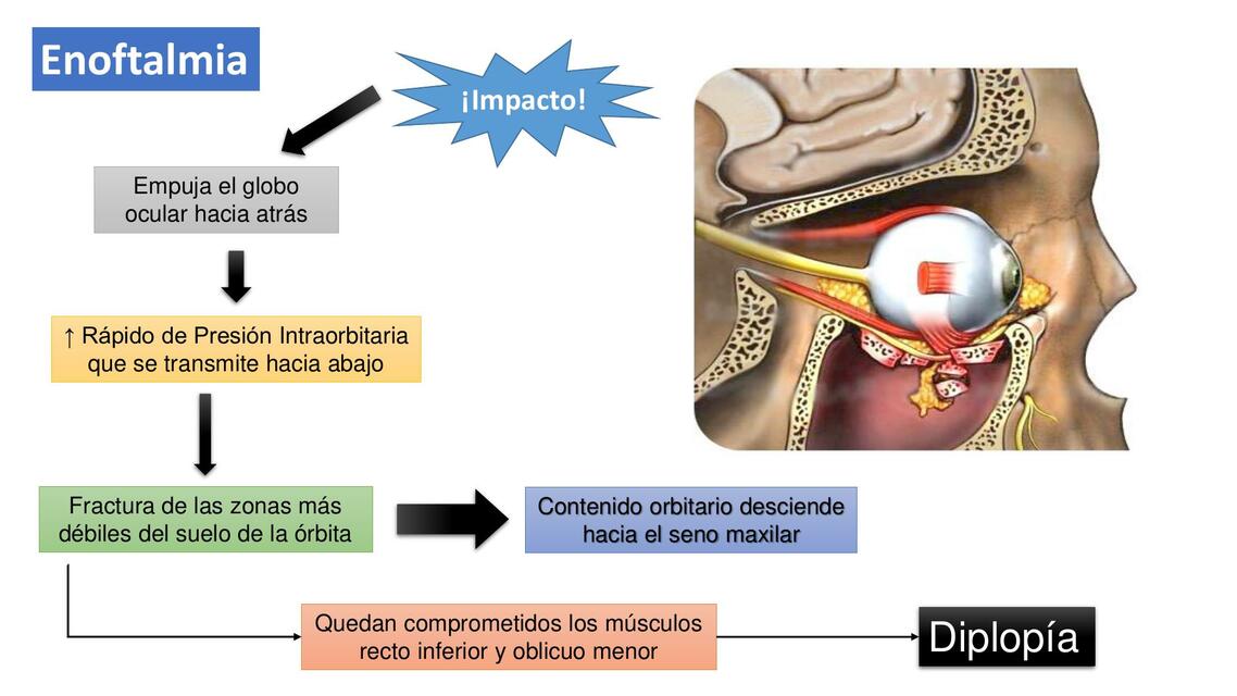 Enoftalmia | Luis Zumaeta | uDocz