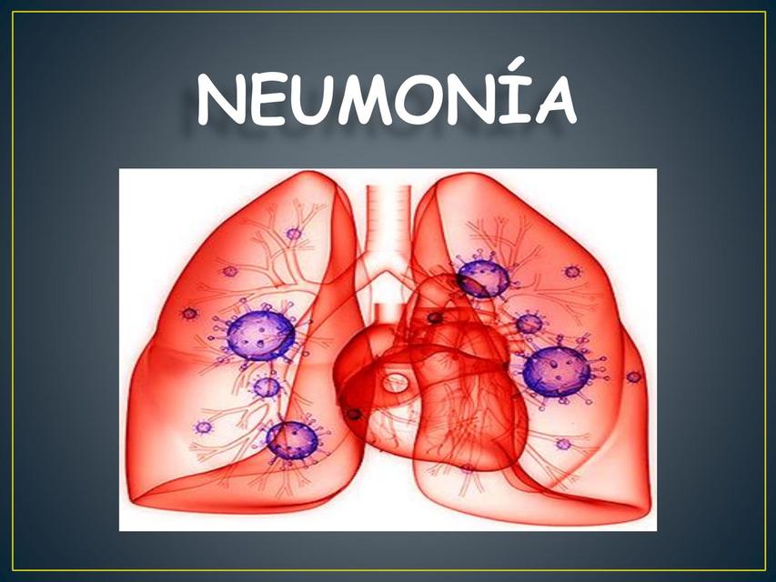 Neumonía | Escuela medica | uDocz