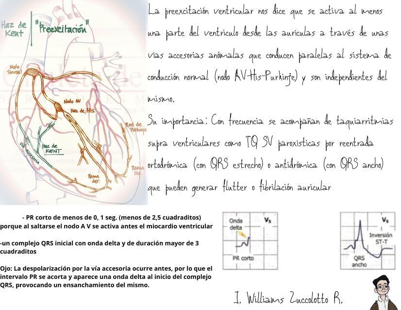 Síndrome de Preexcitación: Haz de Kent