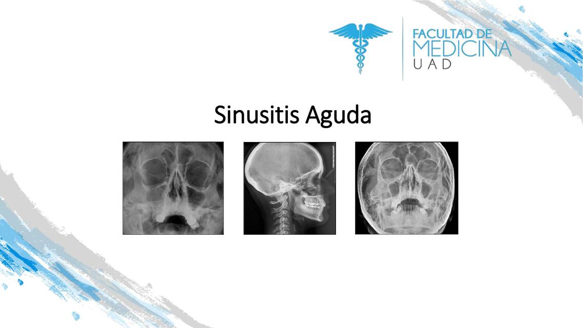 Sinusitis Aguda | Brenda | uDocz