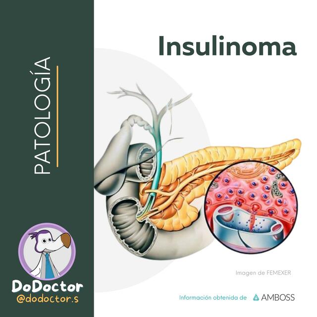 Insulinoma | DoDoctor | uDocz
